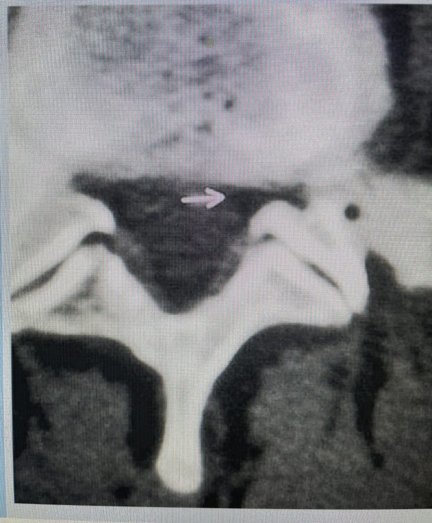 Lateral Recess Stenosis Nspc Brain And Spine Surgery